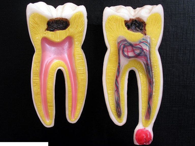 Absceso dental periapical – Causas y tratamiento – hr-dental.com