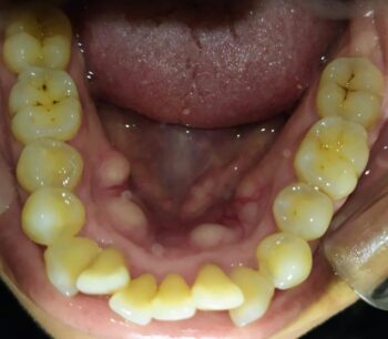 Torus mandibular-¿qué es un rodete mandibular? – hr-dental.com