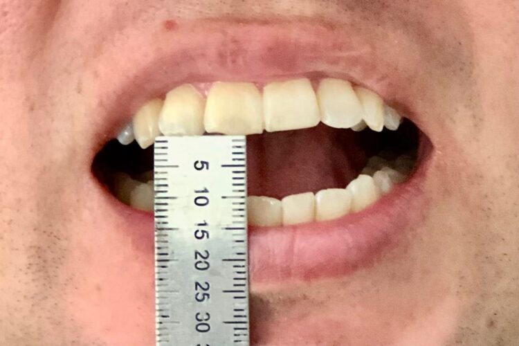 Trismus-¿qué es el trismus? – hr-dental.com