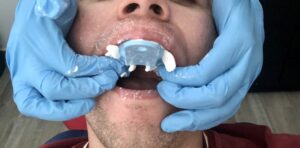 Elaboración de un guarda oclusal de acetato. – hr-dental.com