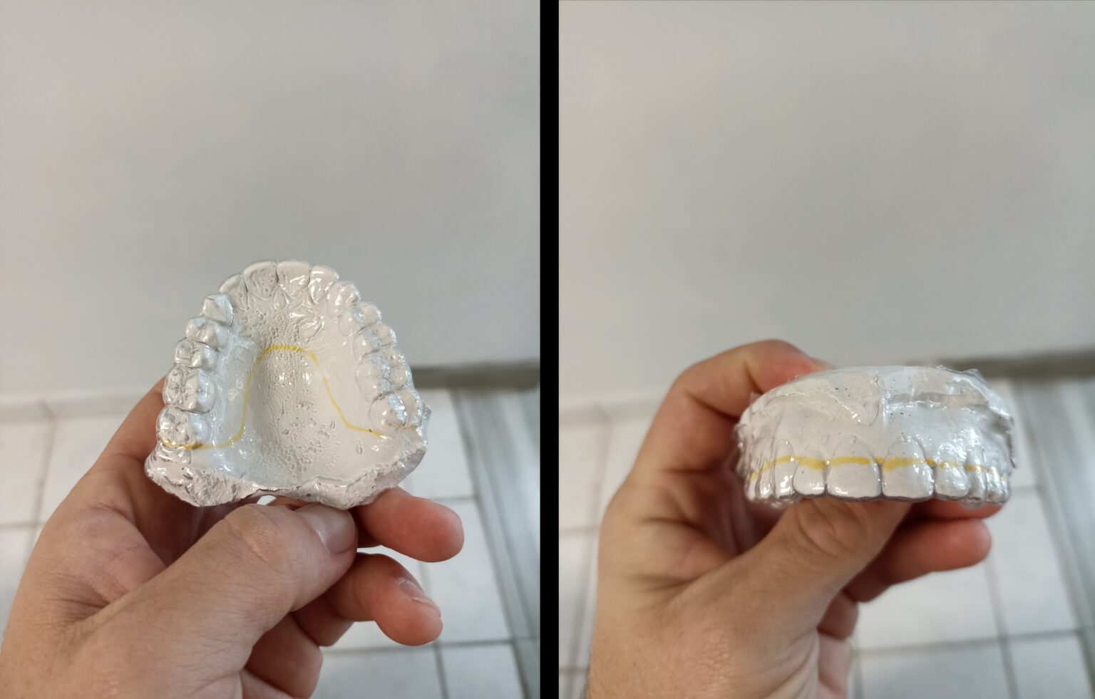 Elaboración de un guarda oclusal de acetato. – hr-dental.com